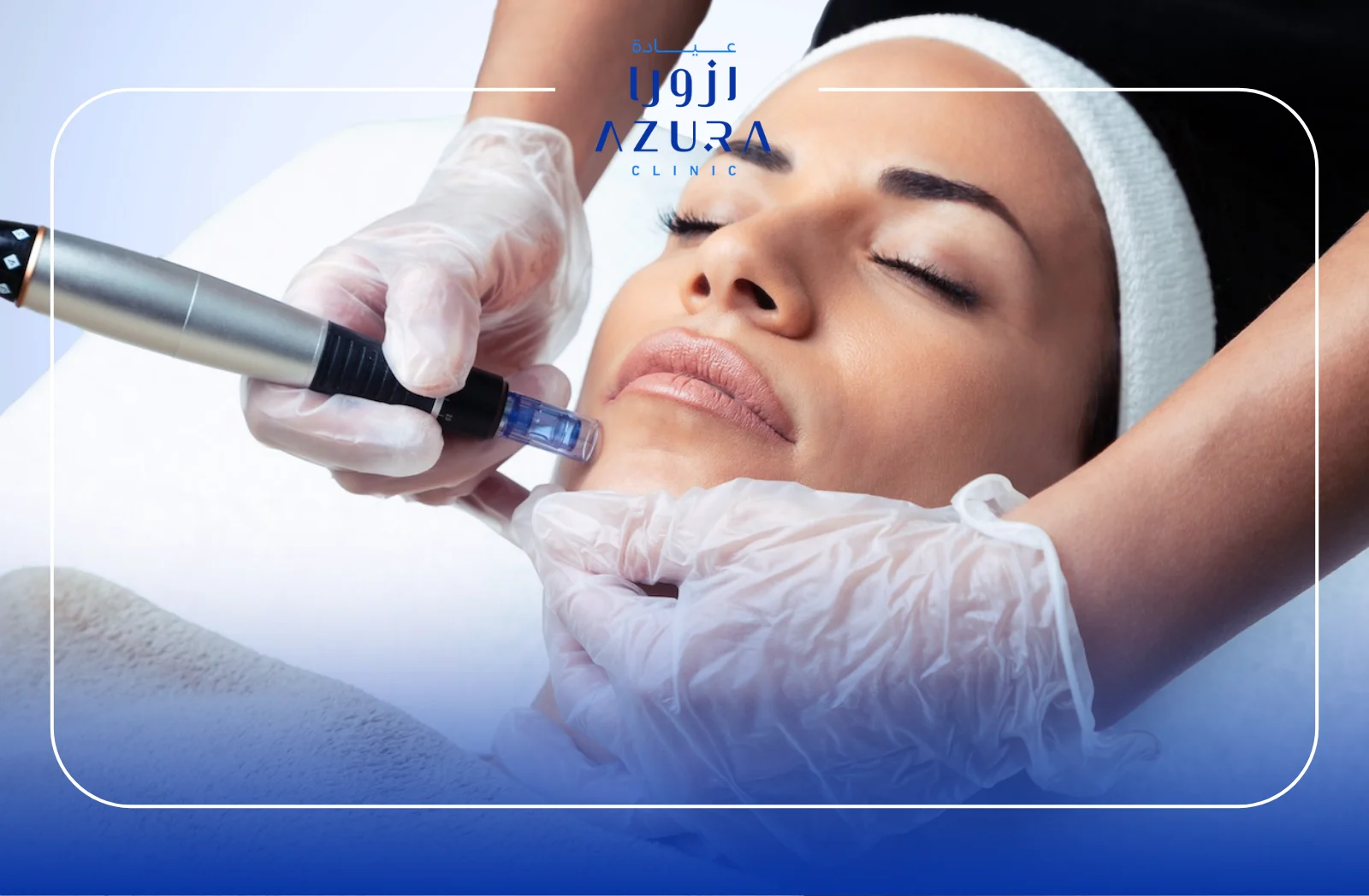 Erase Scars Fast: Reduce Scar with Microneedling + Mesotherapy ...